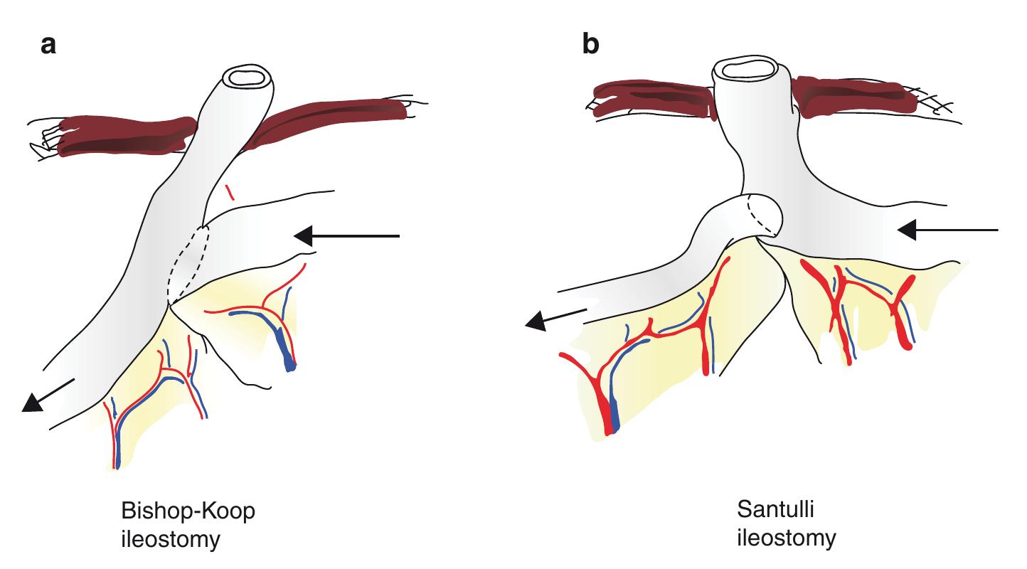 8.1 variations in ileostomy for meconium ileus (a)