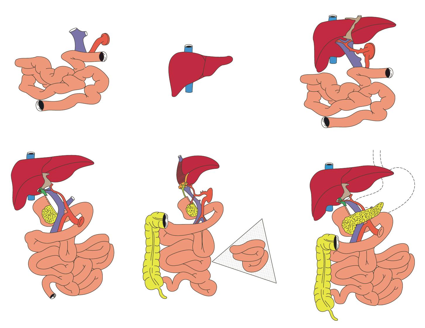 6.1 intestinal atresia classification — (types 1, 2, 3a, 3b,