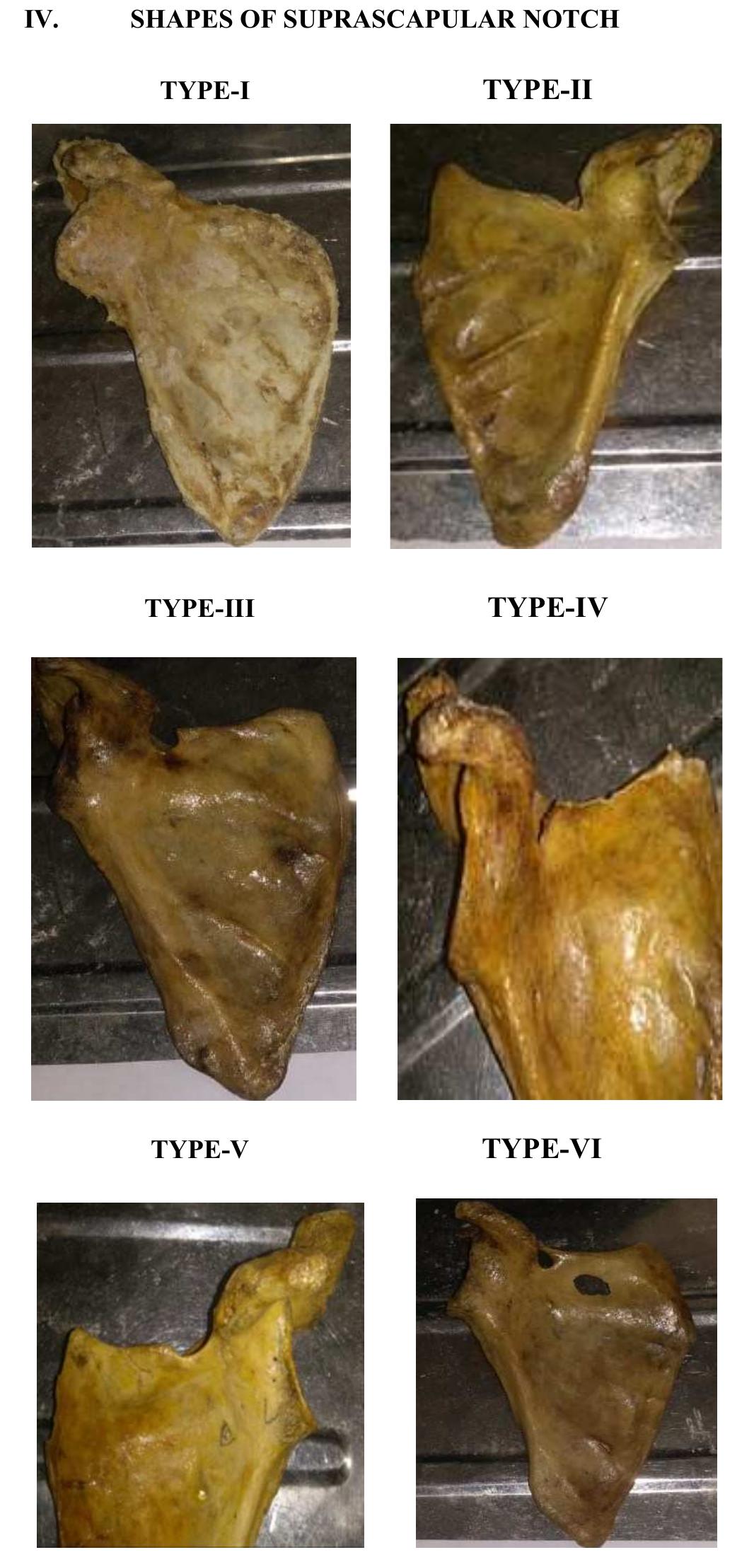 (PDF) Anatomy of Suprascapular Notch (SSN), Suprascapular Nerve ...