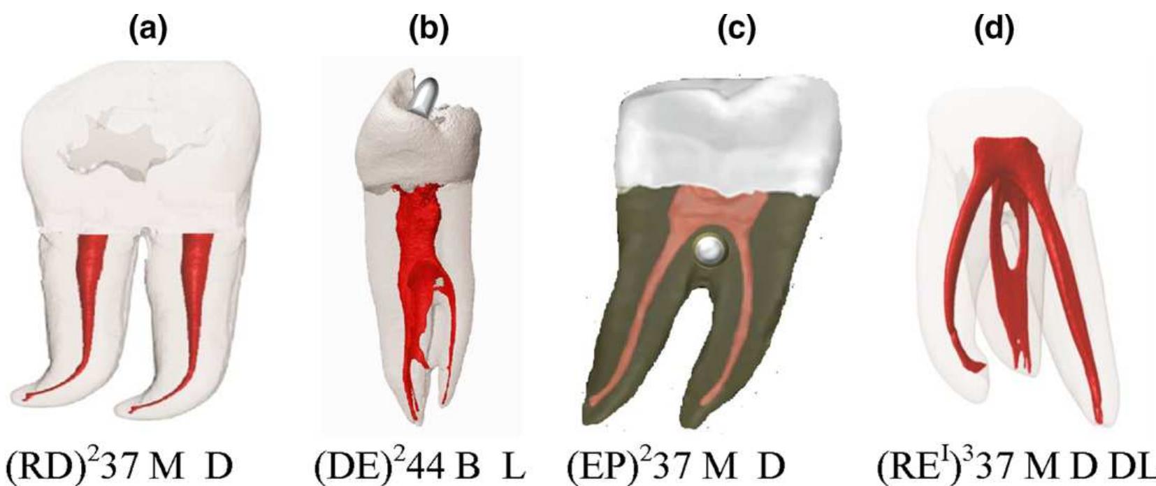 Micro-ct 3d models showing examples for anomalies affecting