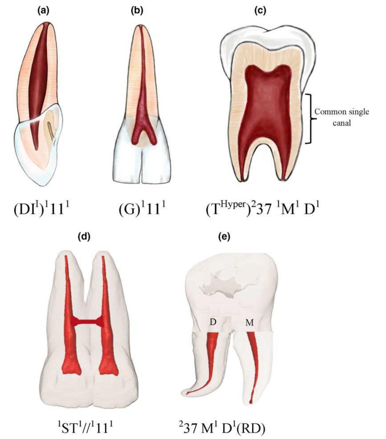 Drawings and micro-ct models showing the application of the