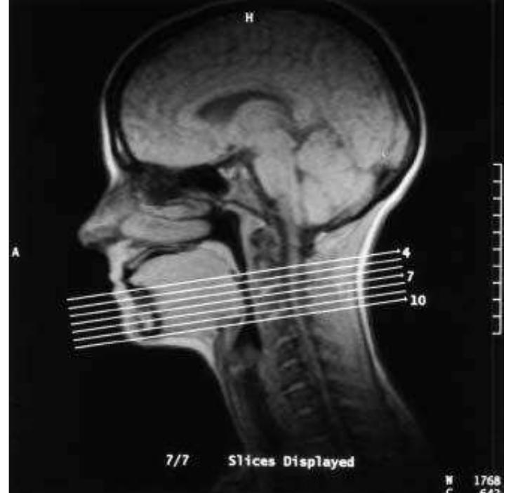 - a low resolution gradient echo sagittal pilot scan used to