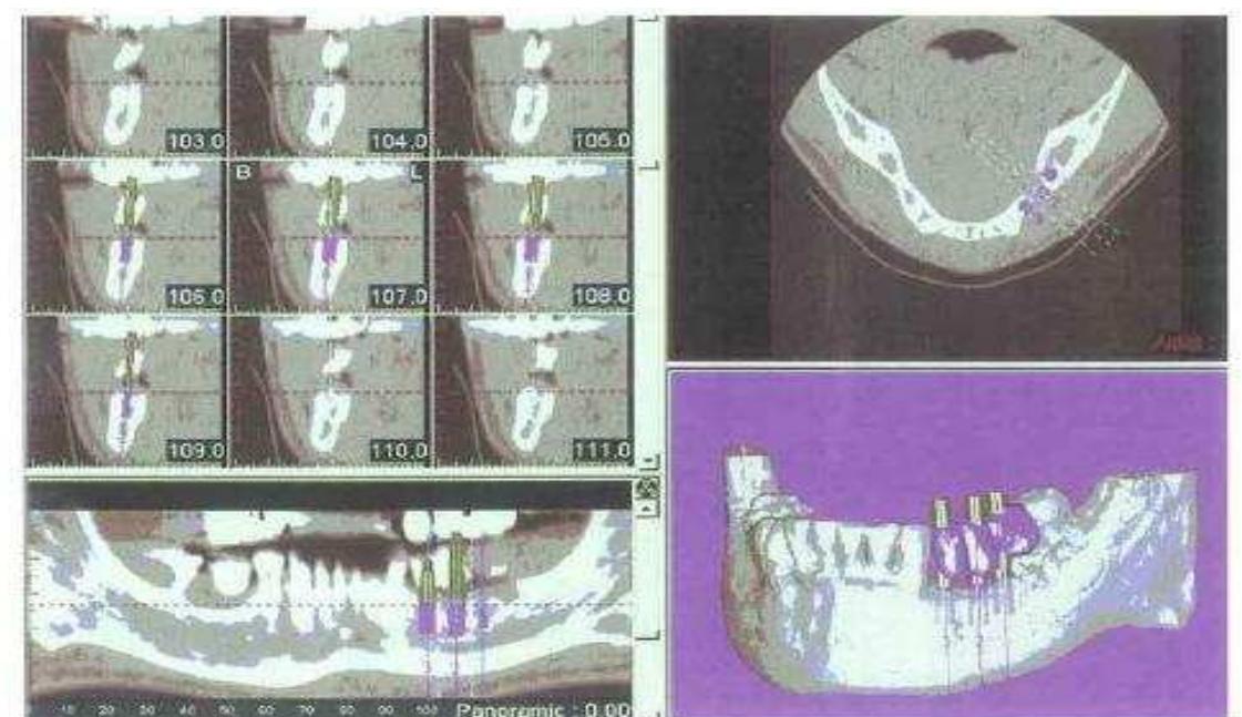 - reformatted computed tomography scan showing the