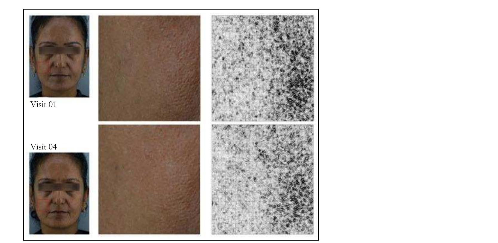 Improvement in skin texture from visit 01 to visit 04.