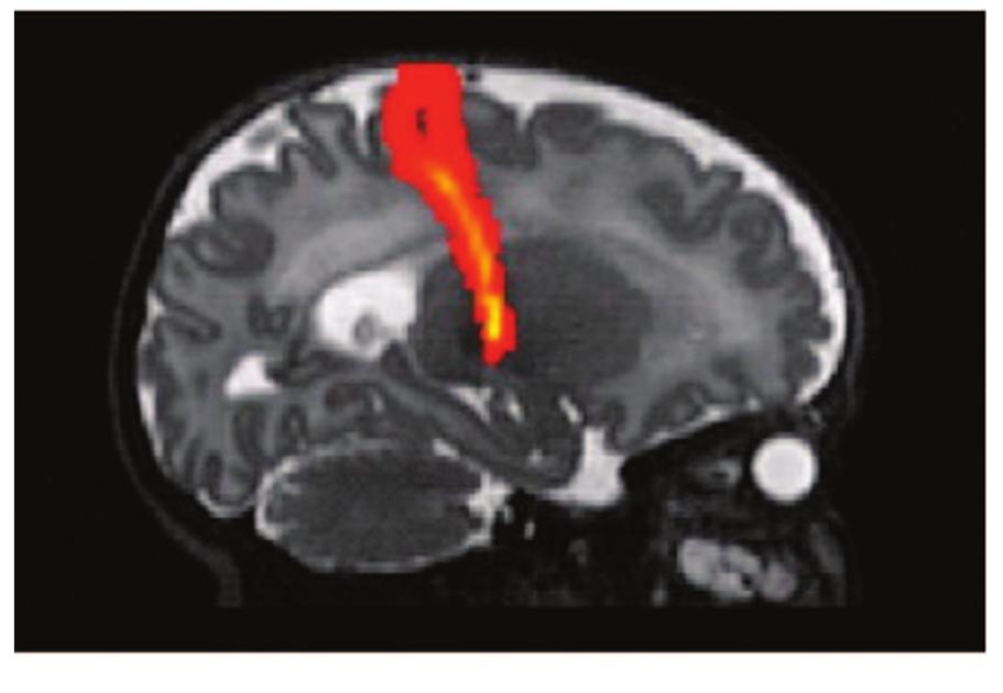 Figure 61 - from DIFFUSION WEIGHTED IMAGING OF THE NEONATAL