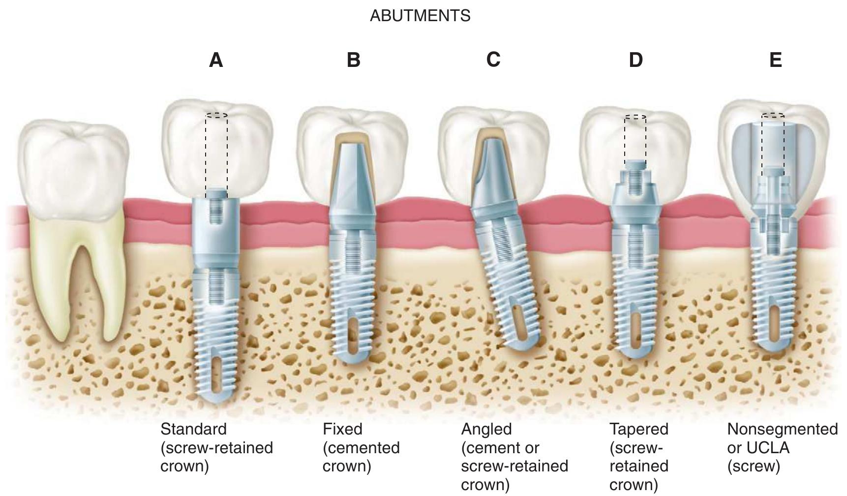 -25 types of abutments (left to right). a, standard. length