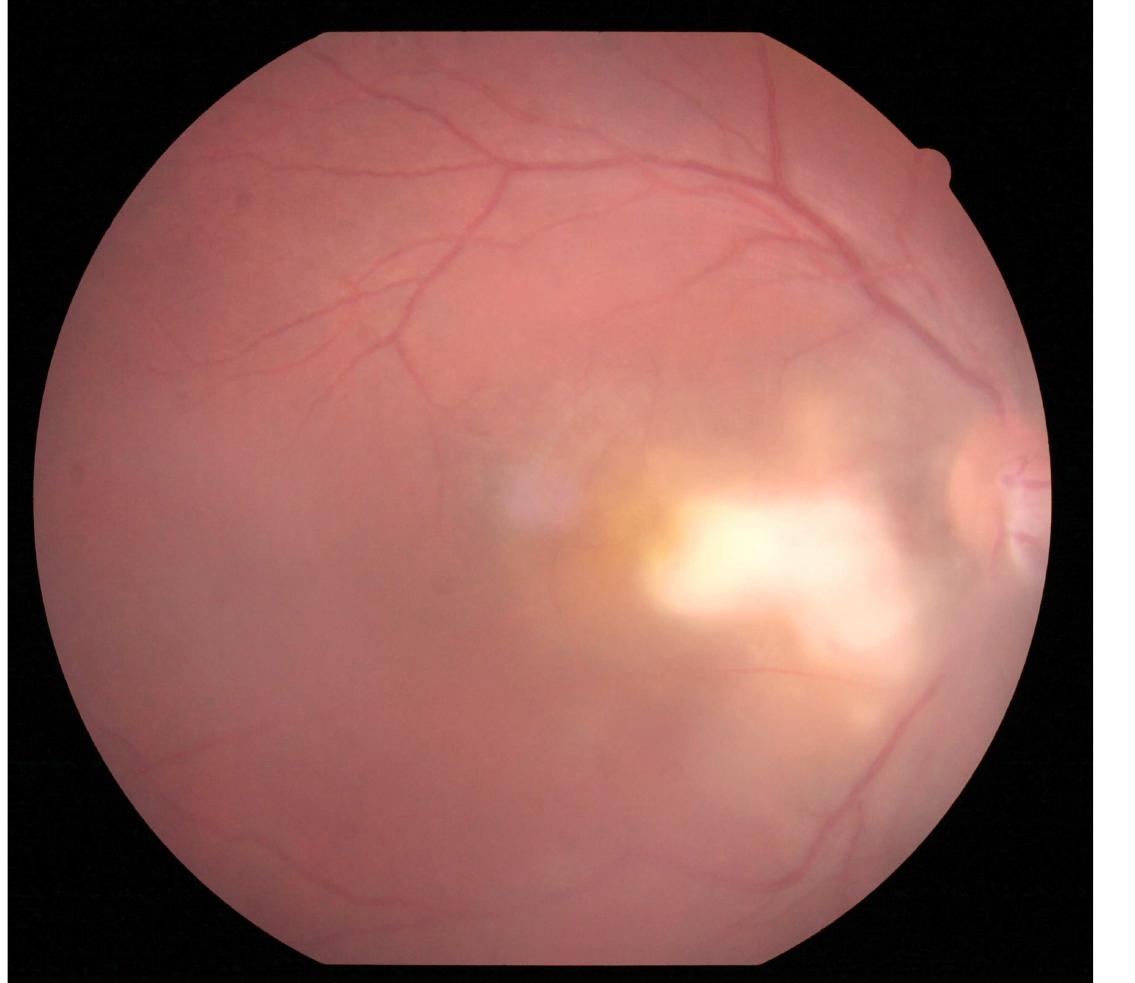 Site of chorioretinal lesions figure 1. fundus picture of