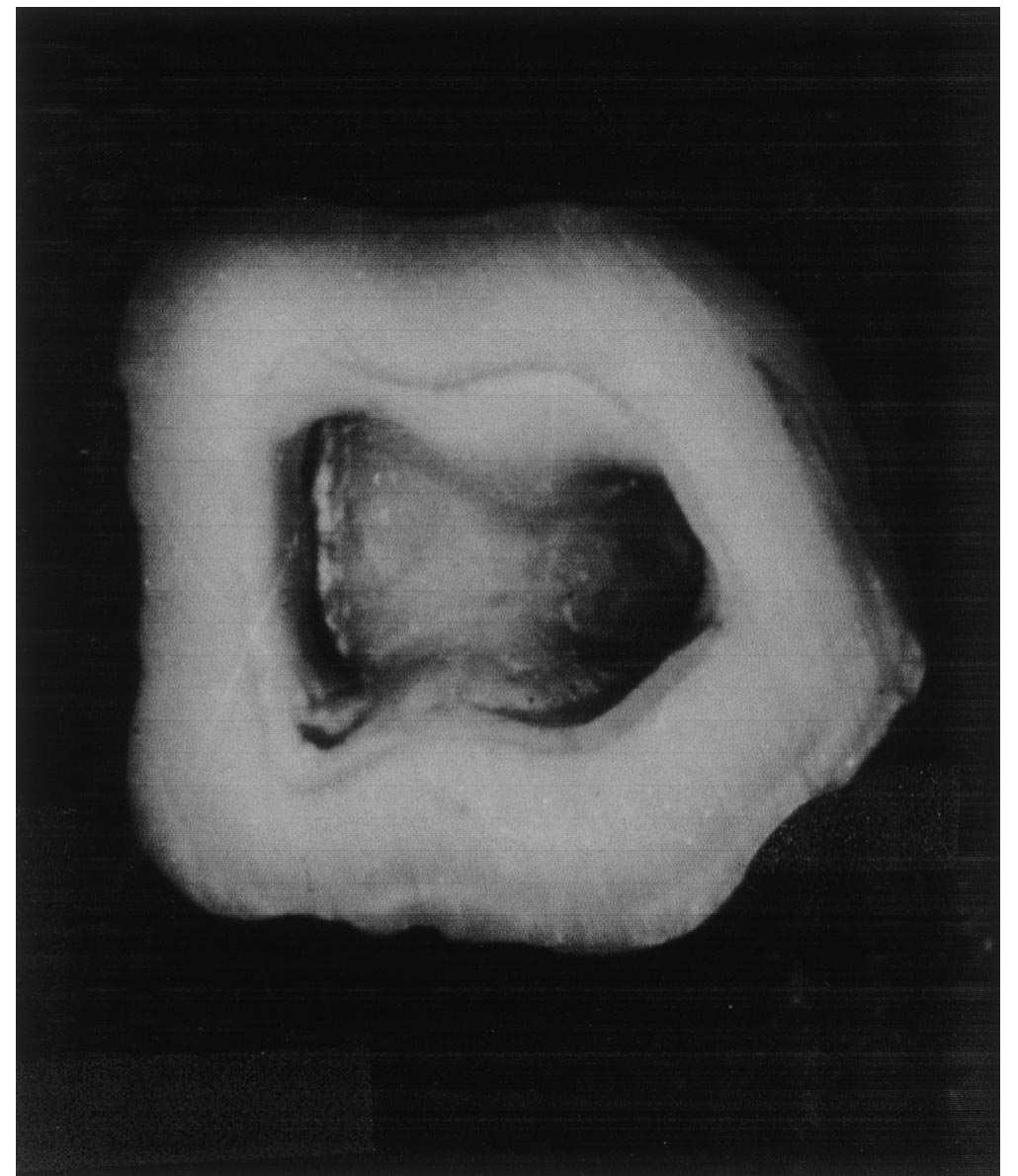 Fia 2. cut specimen of a mandibular molar showing the