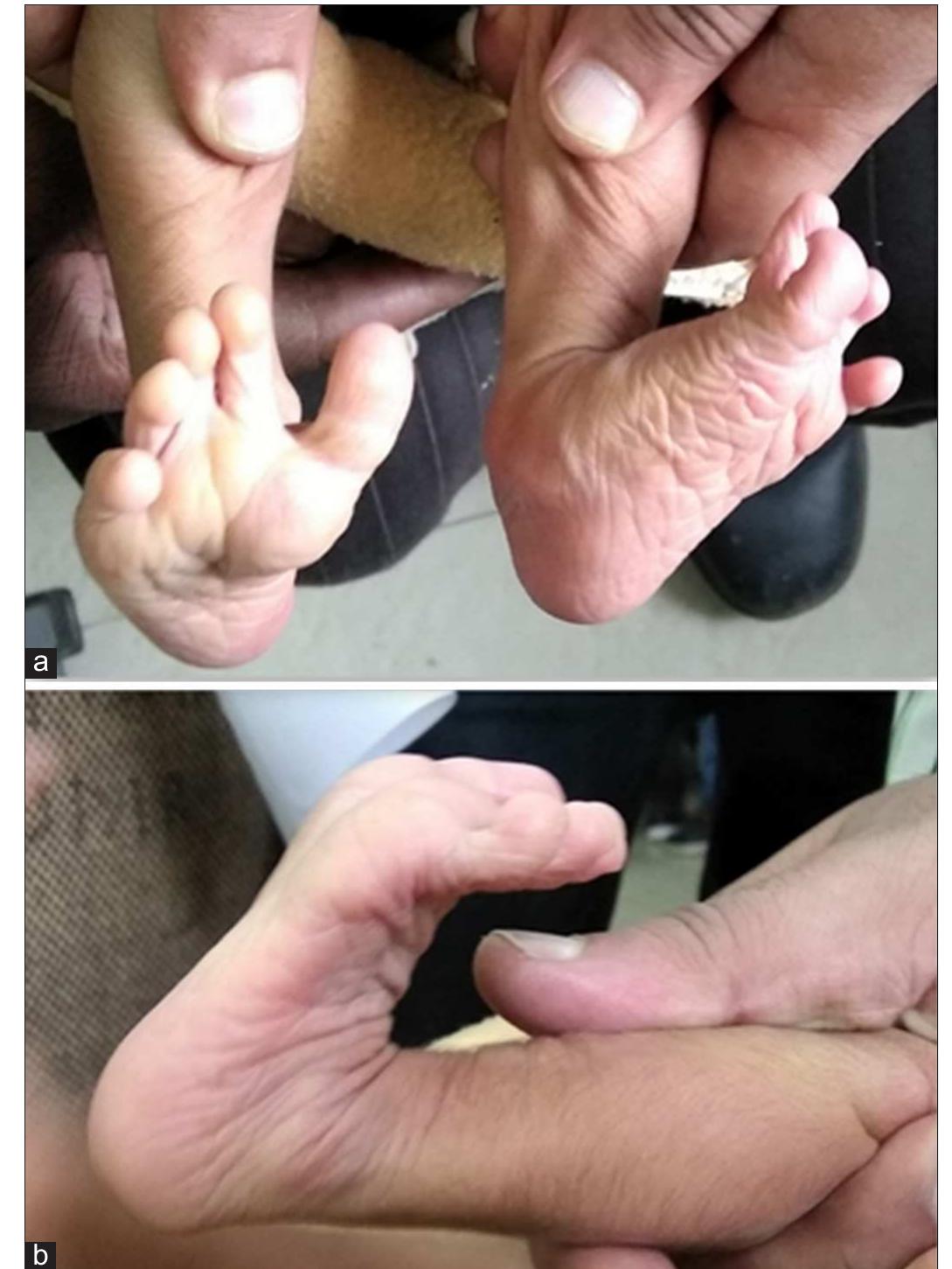 The calcaneovalgus deformity in a newborn (a) from front