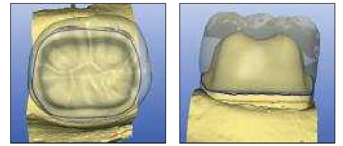 (left) occlusal and (right) buccal views of the cad/cam