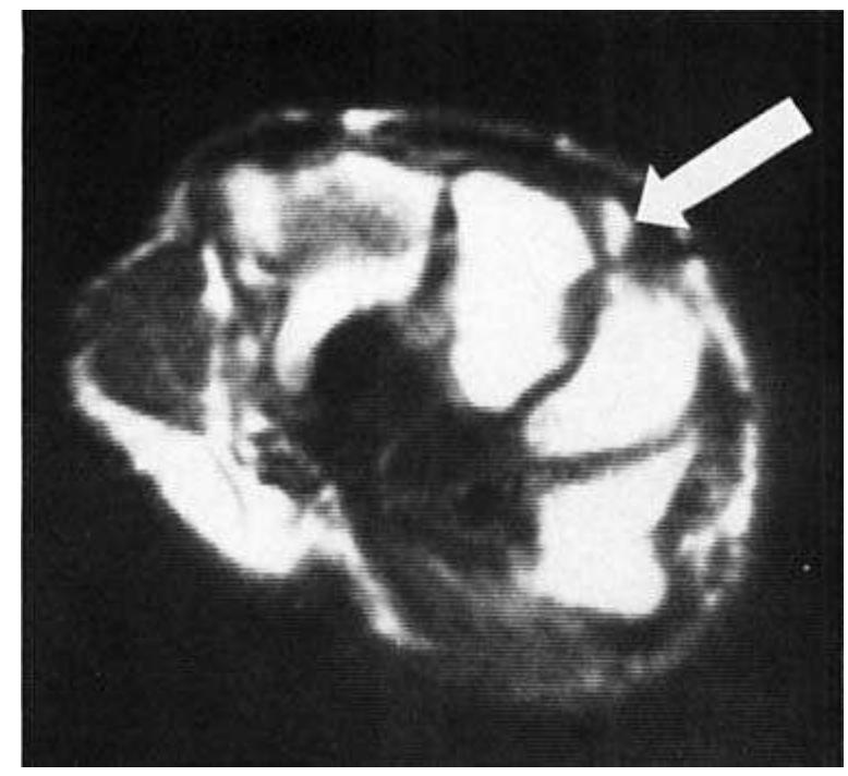 Figure 2 - The third metacarpal styloid process in humans: