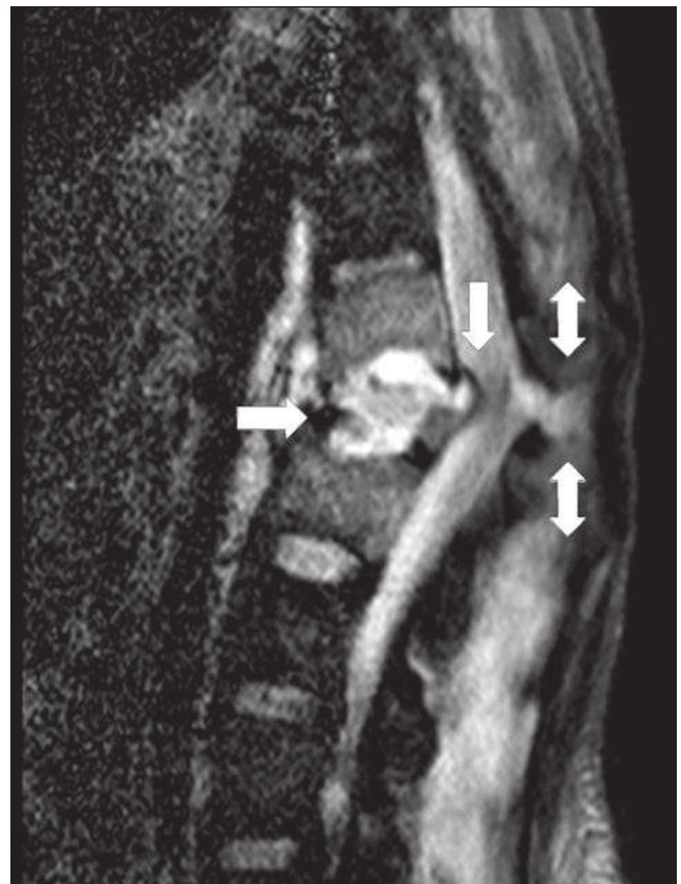 Sagittal stir shows pre-vertebral abscess and diskitis/