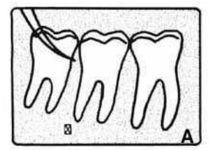 -5 buccal object rule for mandible molars fig-4 buccal