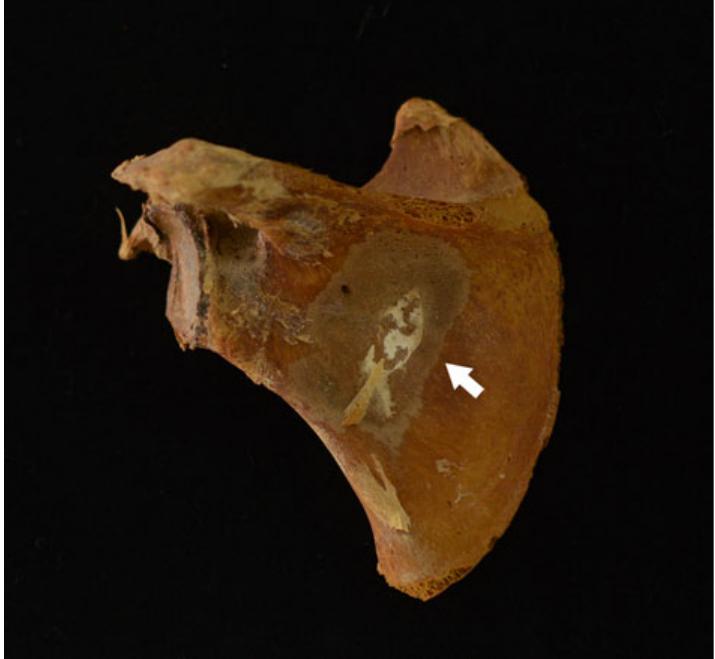 Posterior view of the left scapula of a child with probable