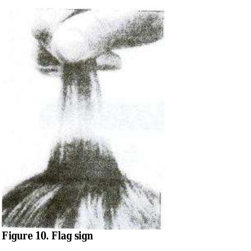 Objaw flagi dyspigmentation of the hair occurring as a band