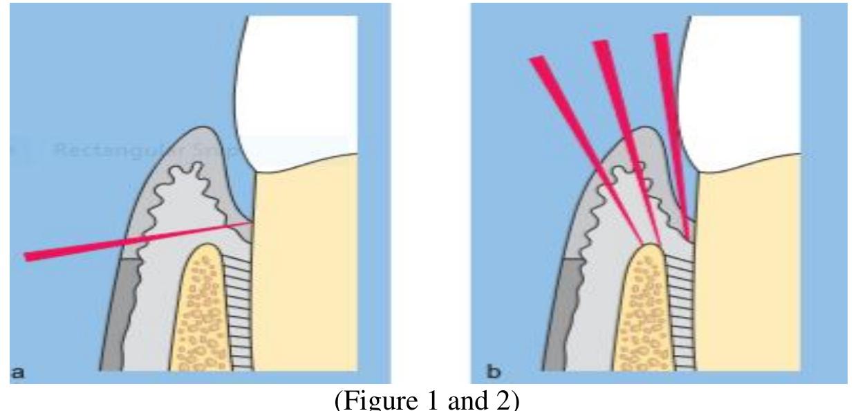 (PDF) INCISIONS AND TISSUE MANAGEMENT IN PERIODONTAL SURGERY: A ...