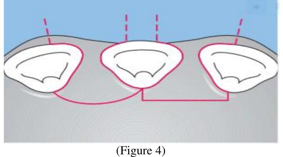 (PDF) INCISIONS AND TISSUE MANAGEMENT IN PERIODONTAL SURGERY: A ...
