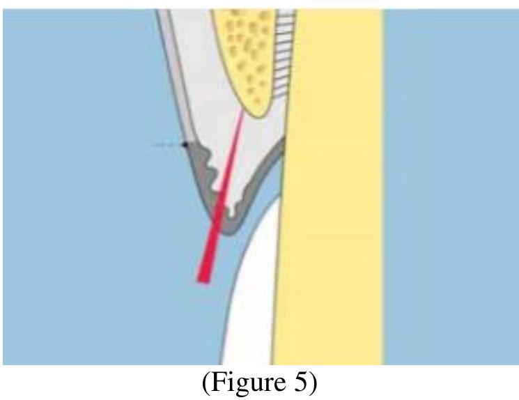 (PDF) INCISIONS AND TISSUE MANAGEMENT IN PERIODONTAL SURGERY: A ...