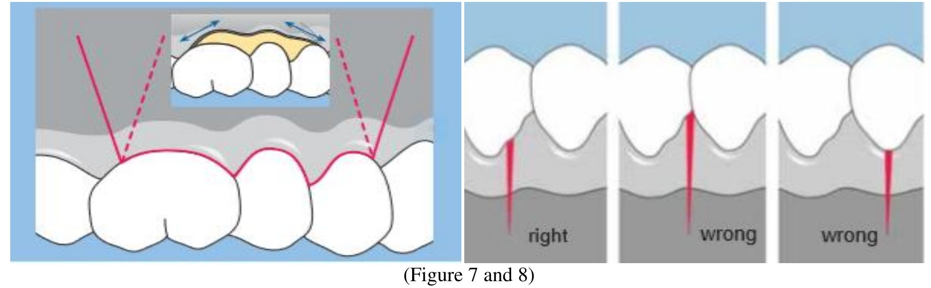 (PDF) INCISIONS AND TISSUE MANAGEMENT IN PERIODONTAL SURGERY: A ...