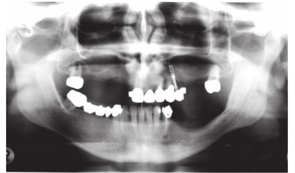 Pre-surgical ortopantomography (opg) before surgery,
