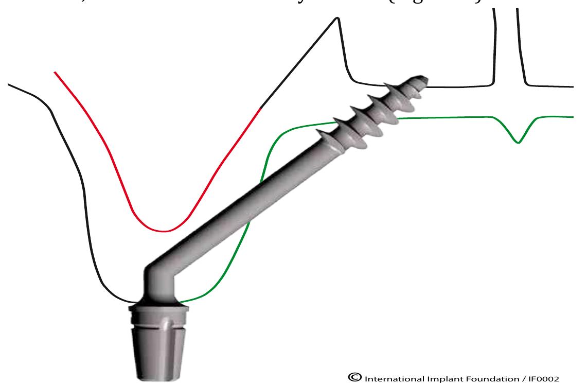 If the implant enters the upper alveolar crest and