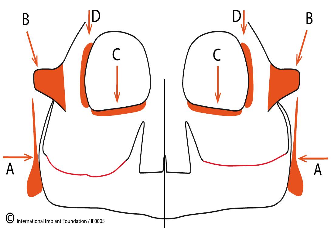 Of the maxillary bone and are anchoring into an adjacent