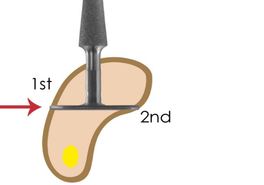 Lateral basal implants are inserted from the lateral into