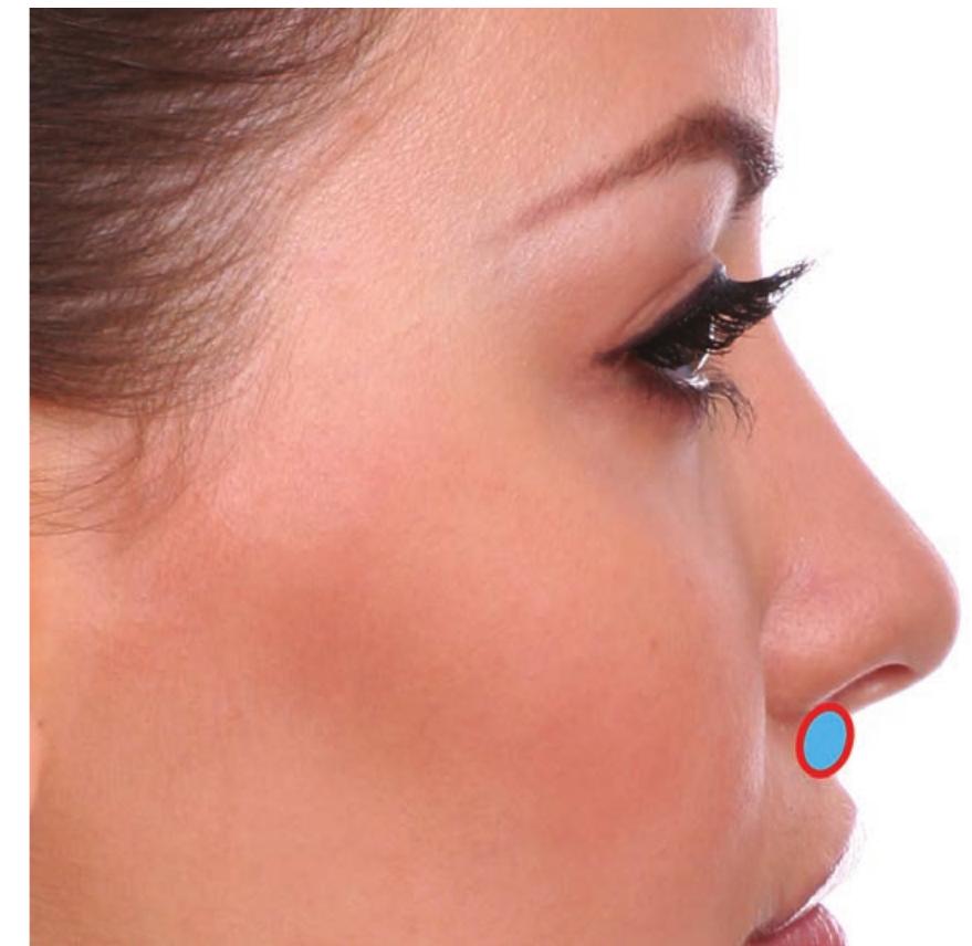 Increasing the nasolabial angle with ultra plus or voluma. a