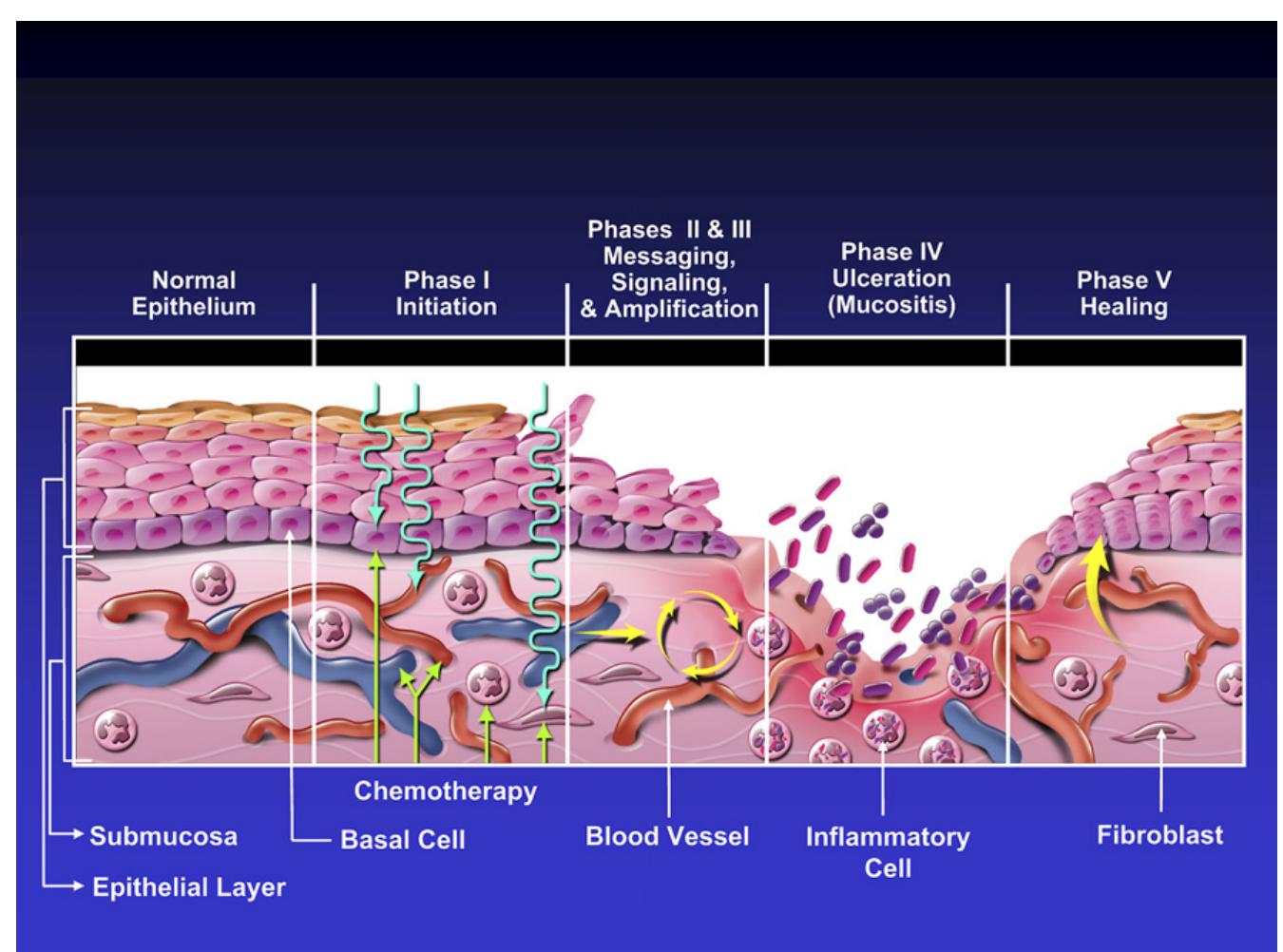 Figure 1 - from Management of Oral Mucositis in Patients Who