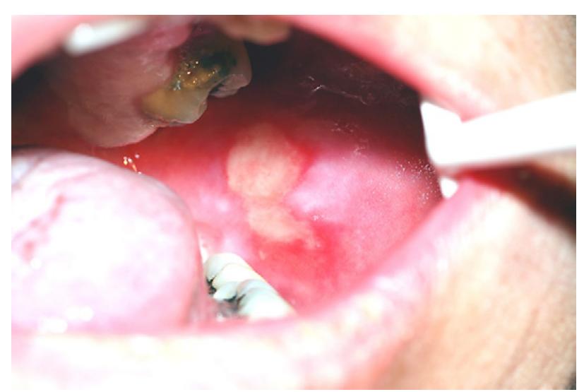 Mucositis ulcer involving the buccal mucosa in the same