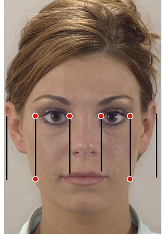 The rule of fifths: the face is divided sagitally into five