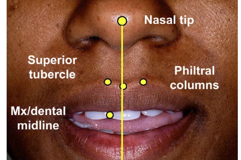 Maxillary dental midline to midsagittal plane. true