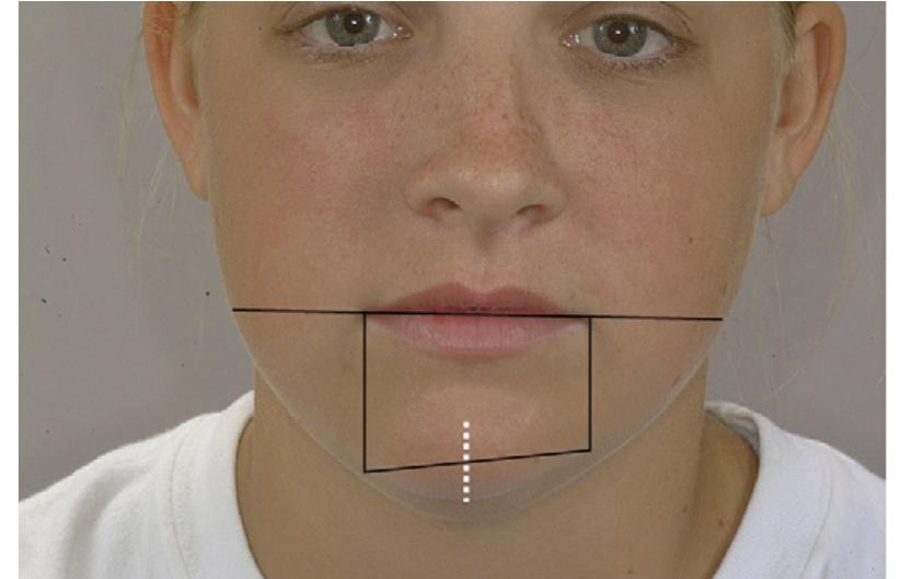Measurement of the midsymphysis to the midsagittal plane is