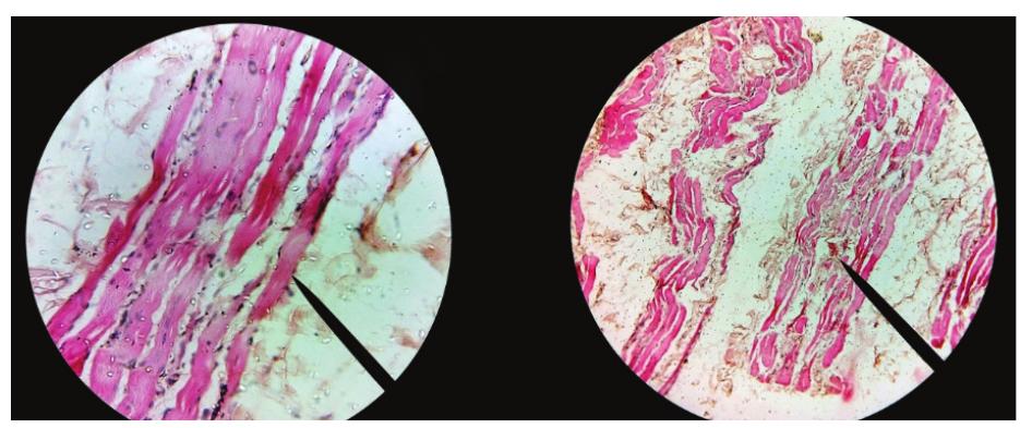 Histology result from biopsy of the calf muscle. the arrow