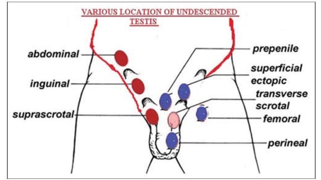 Various location of testes cryptorchidism is a defect