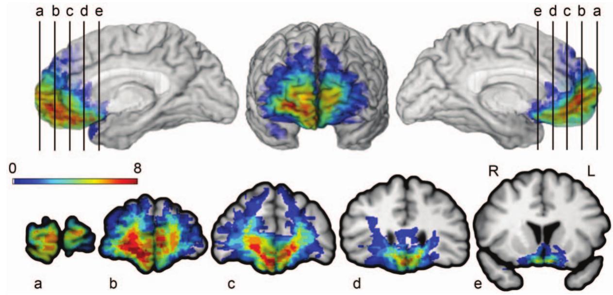 I. lesion overlap map for the medial prefrontal cortex