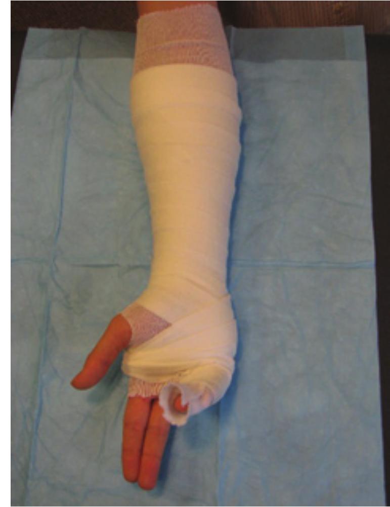 (PDF) Principles of Casting and Splinting