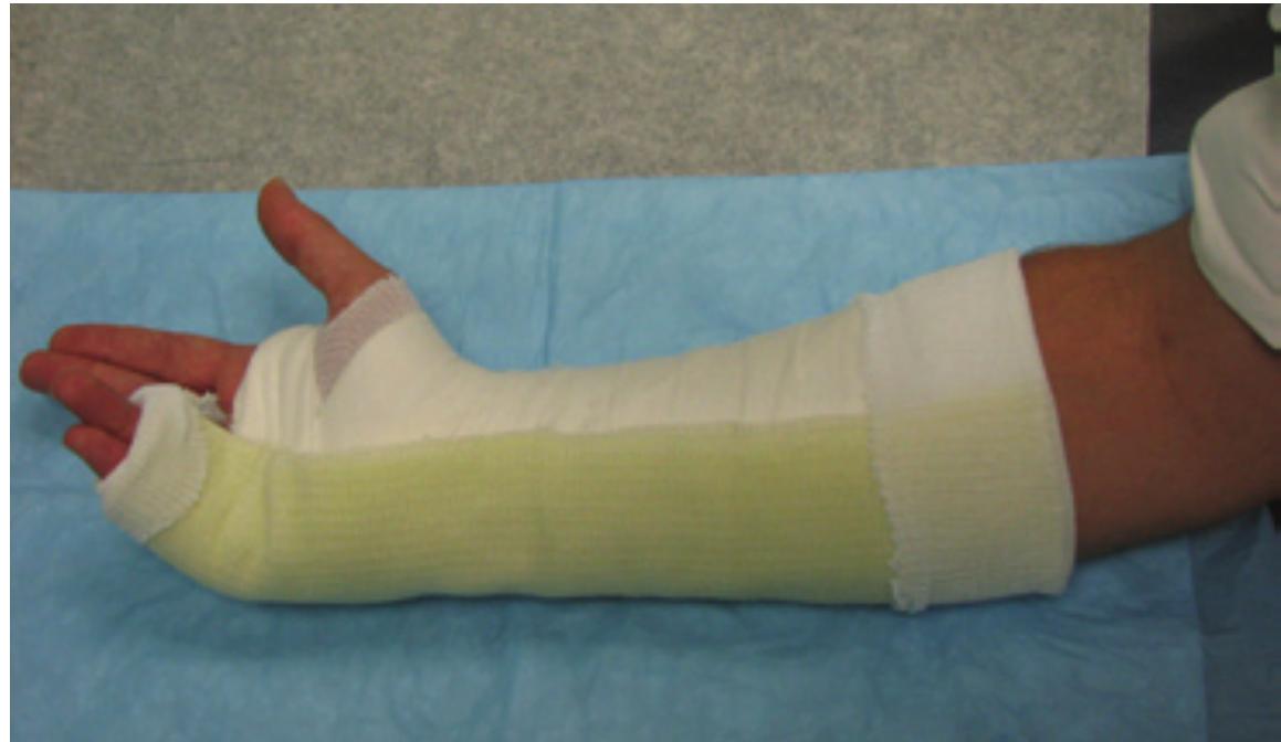 (PDF) Principles of Casting and Splinting