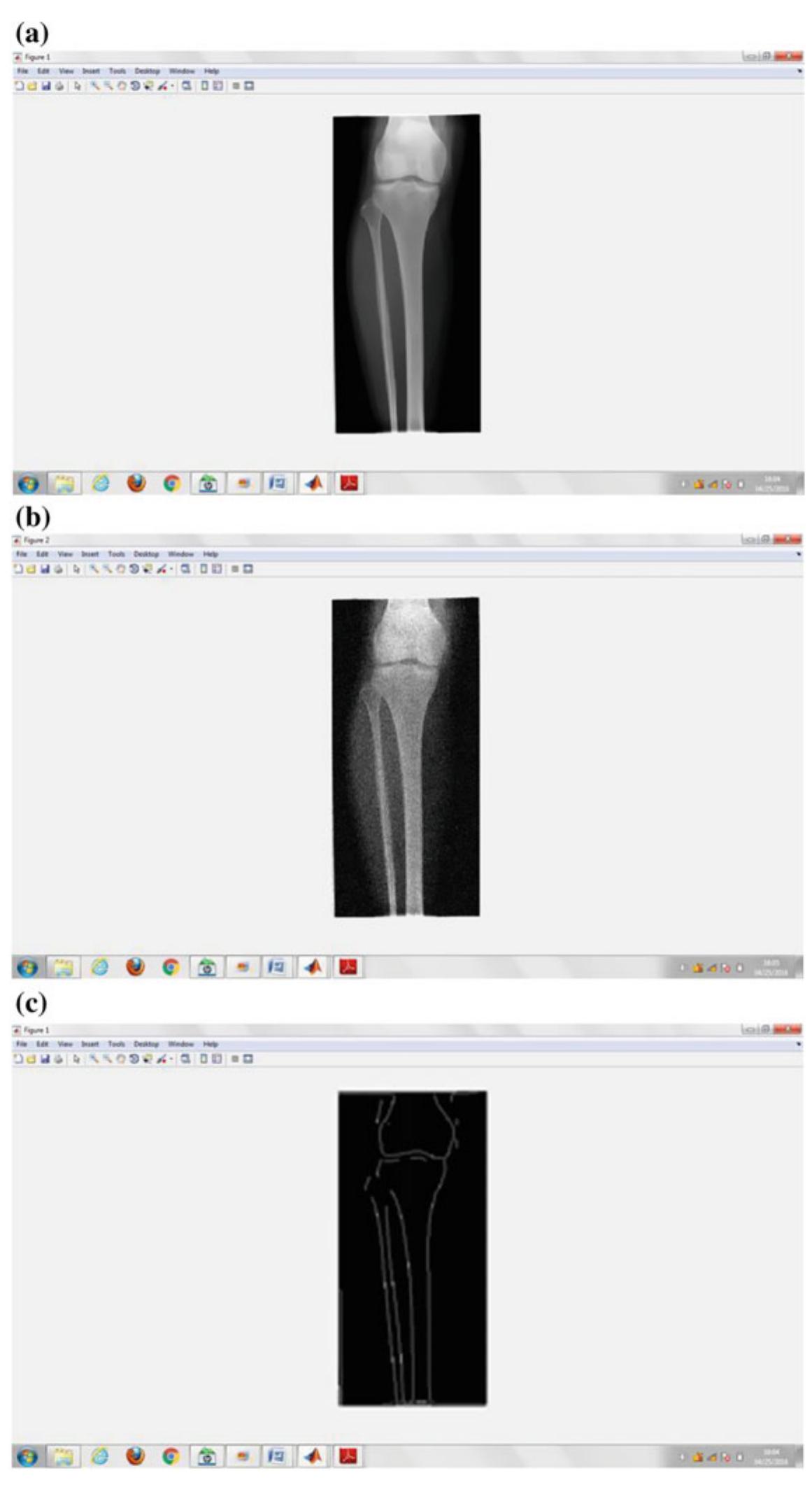Figure 5 - Bone Fracture Detection Using Edge Detection