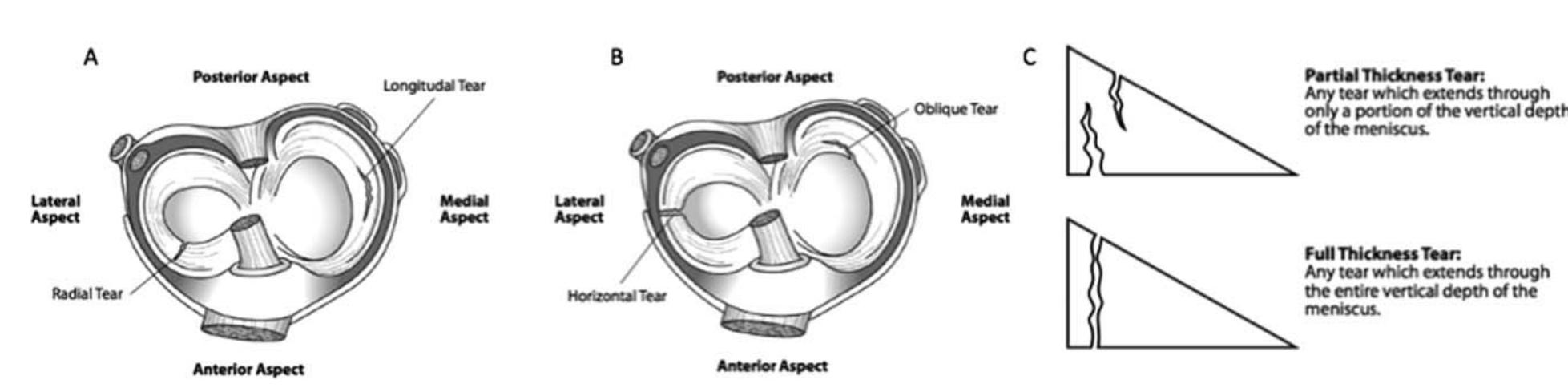 Common types of meniscal tears (a and b) and; (c) depth of