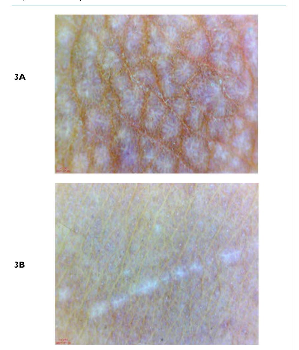 Dermoscopy of skin lesion shows shiny, rounded, and bluish