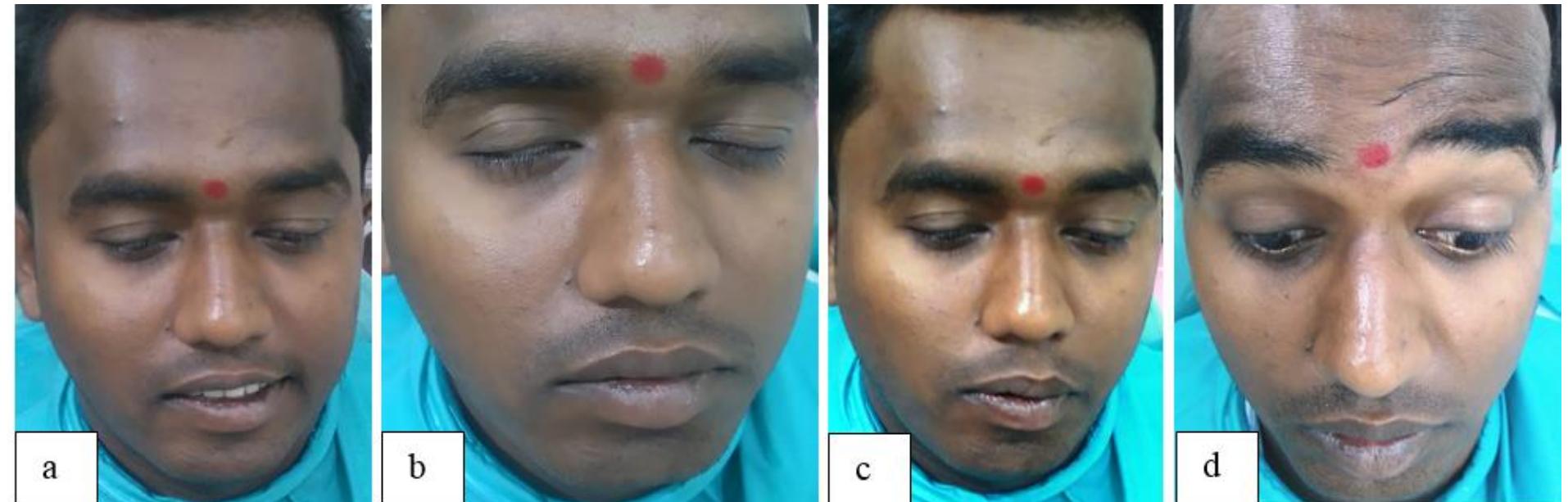 Facial aspect of patient showing bell’s palsy on the right