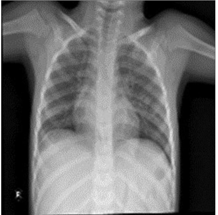 Posteroanterior view of chest radiograph at 4-week follow-up