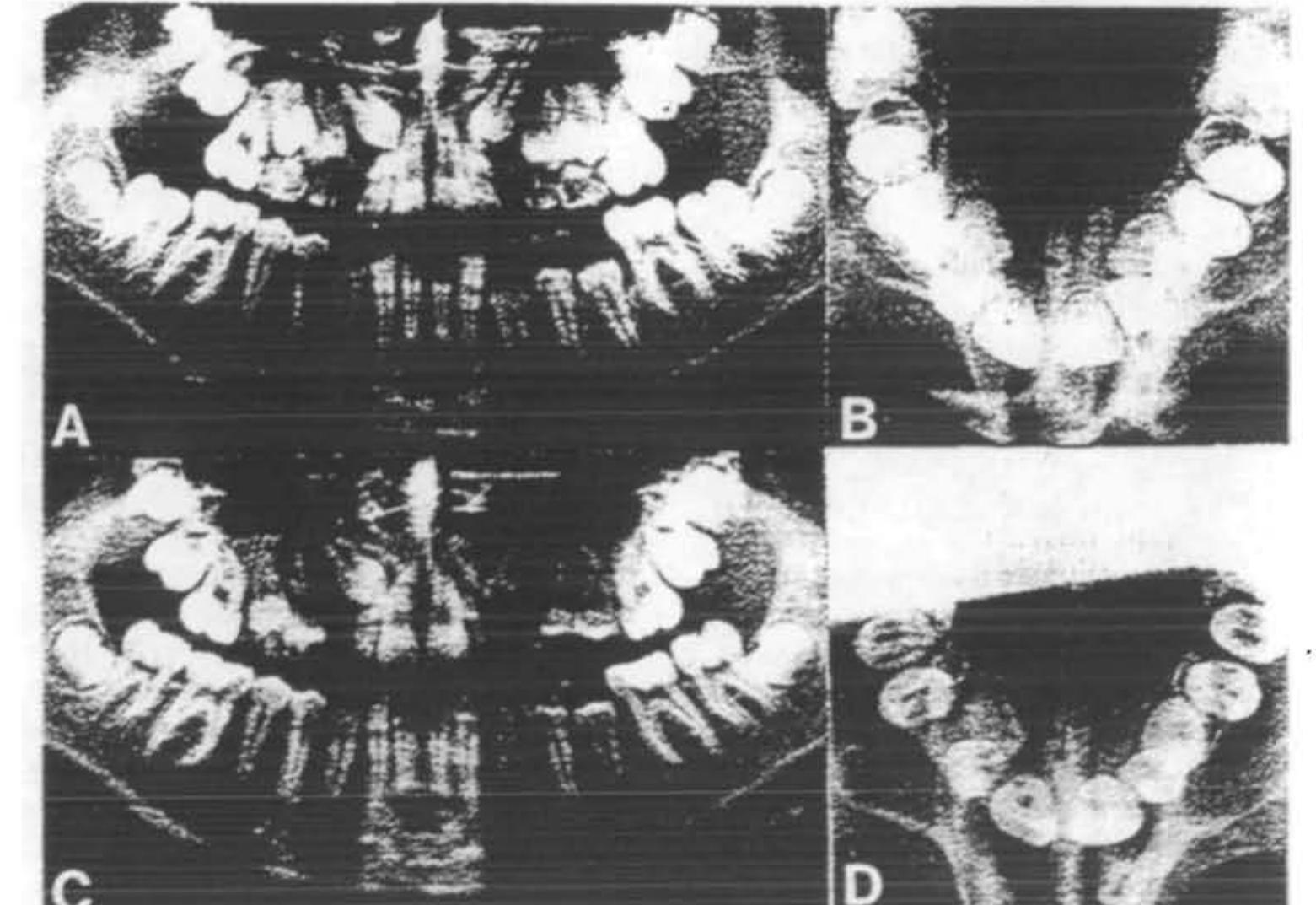 Palatal ectopic eruption of both maxillary canines in a boy