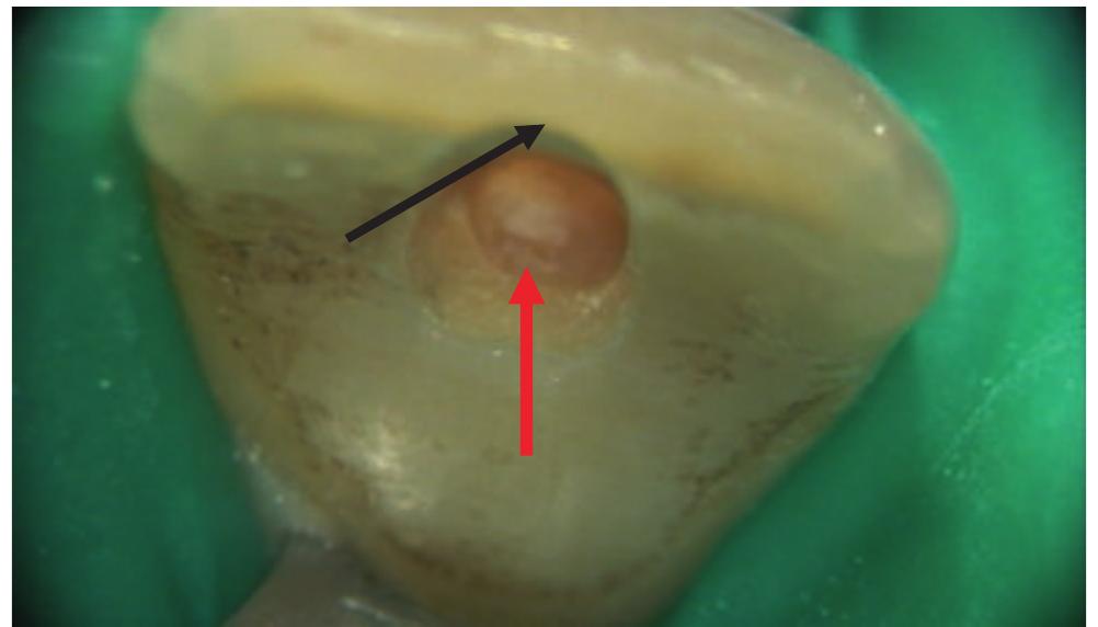 Tooth seen in fig. 3. it is isolated under rubber dam with