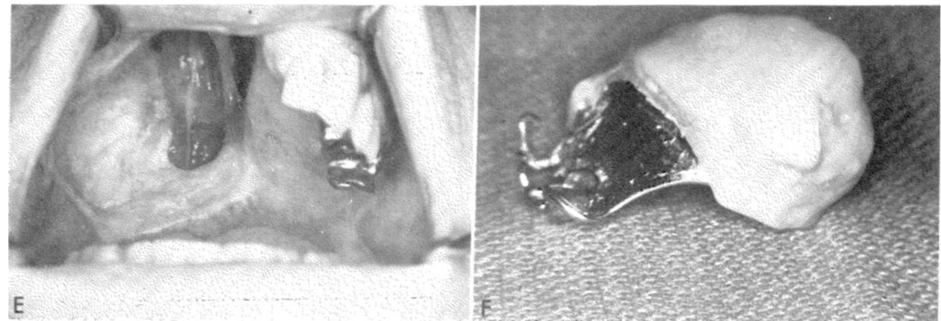 , e and f, e, the pharyngeal wall of a maxillary defect.