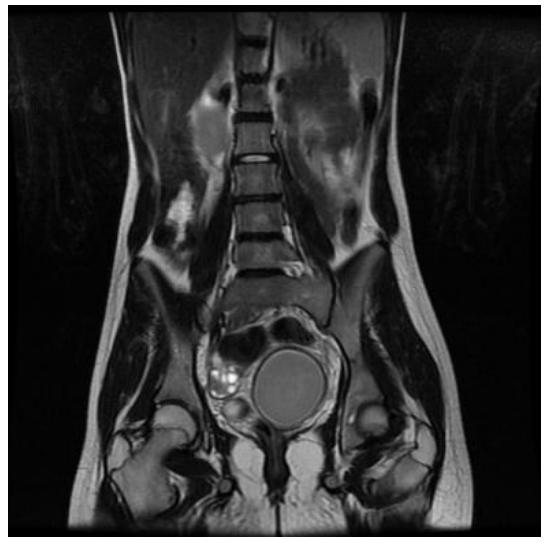 : coronal t1 weighted mri of cervix and the uterus cavity
