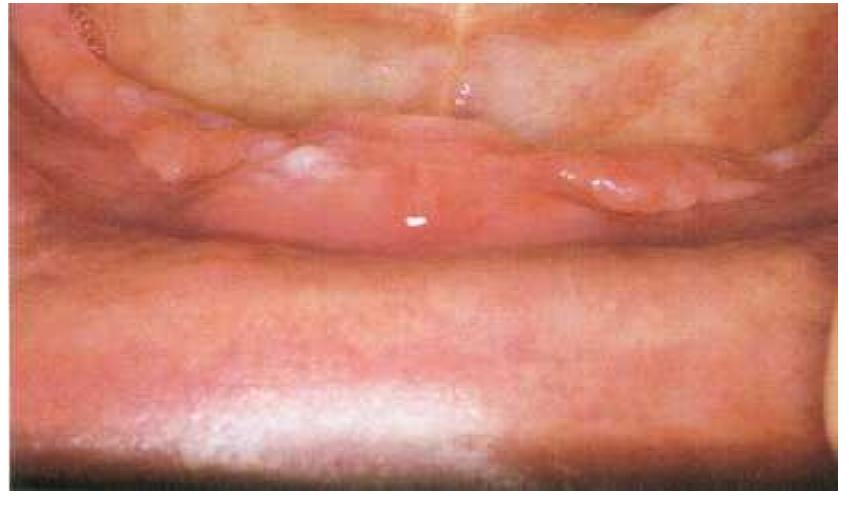 Denture hyperplasia of lower ridge.