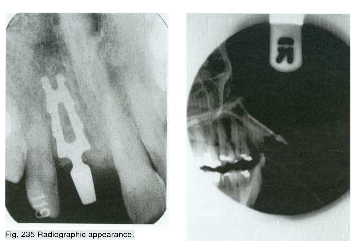 Blade-vent implant. fig. 235 radiographic appearance fig.