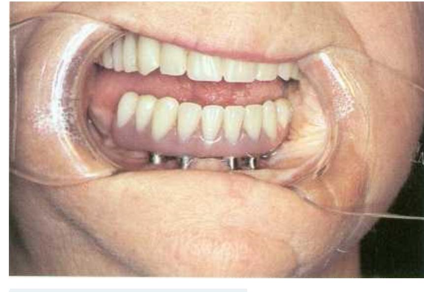Fixed mandibular prosthesis.